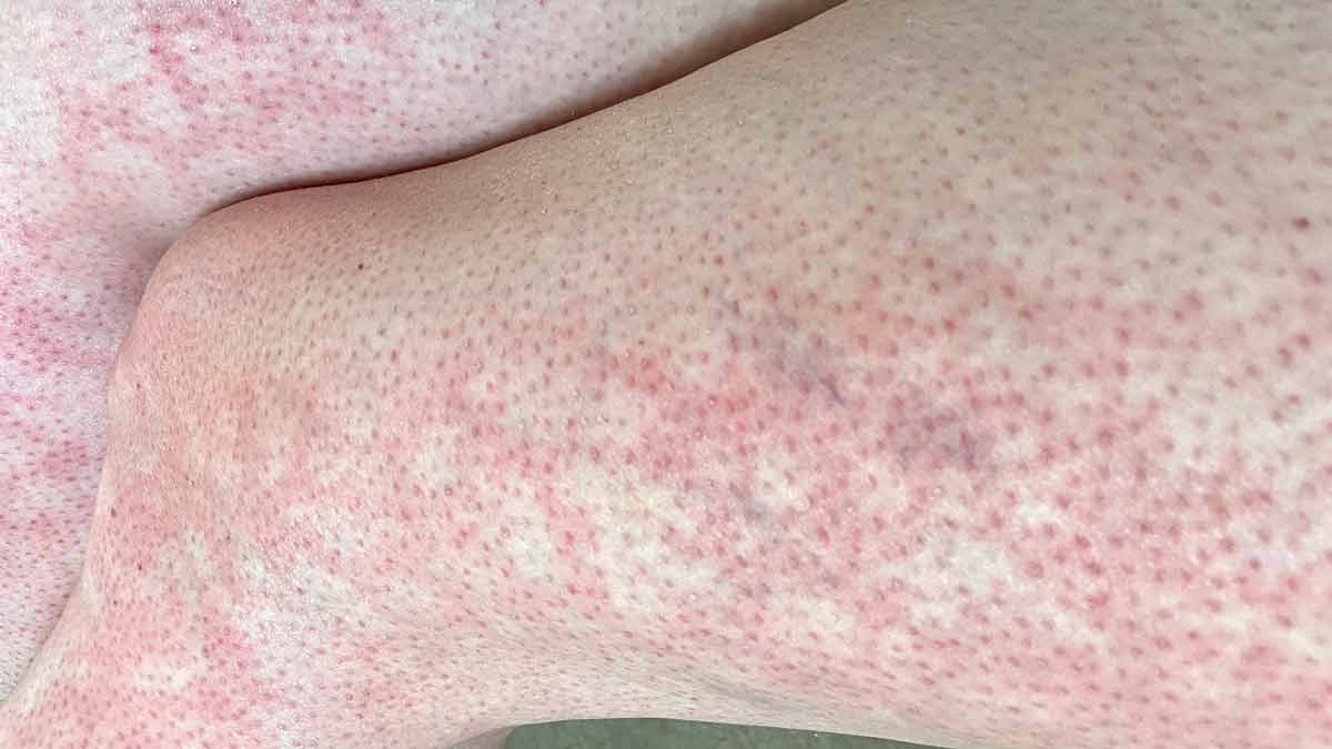 What is Toasted Skin Syndrome | Ohio State Health & Discovery